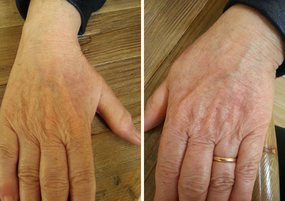 Biorivitalizzazione e Ringiovanimento - IDI